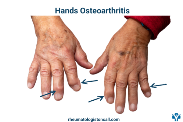 How To Treat Hand Osteoarthritis At Home? » Rheumatologist OnCall