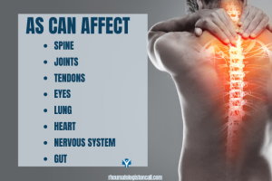 How Does Ankylosing Spondylitis Affect Your Eyes?