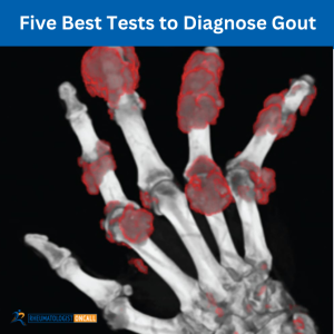5 Best Tests For Gout | Diagnosis & Treatment