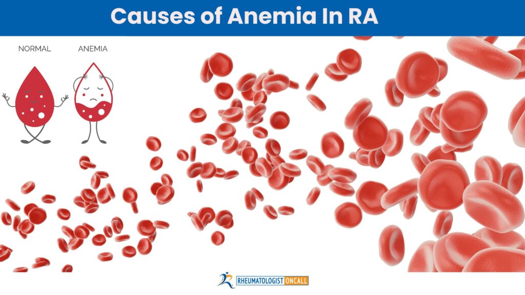 Rheumatoid Arthritis and Anemia » Rheumatologist OnCall