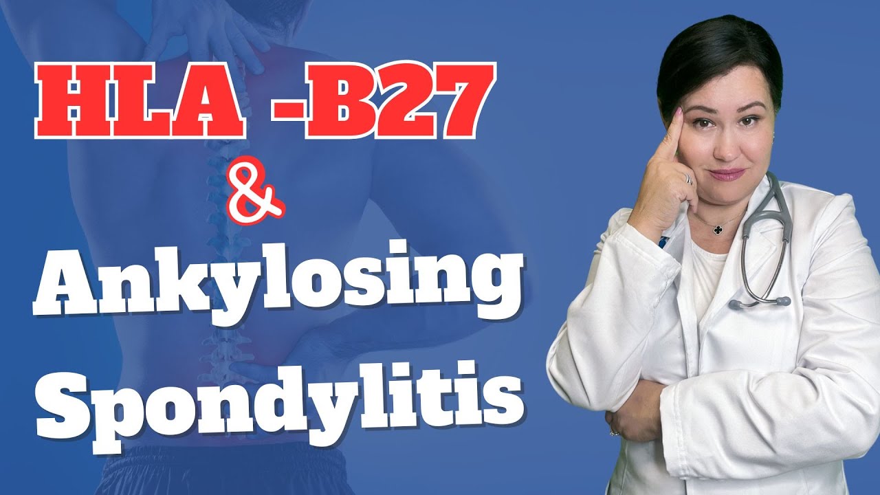 Ankylosing Spondylitis -Is HLA-B27 Essential for Diagnosis?